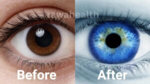 Iris Implant Surgery | Types, Procedure, Benefits & Recovery Guide