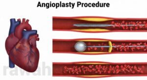 Angioplasty Procedure in India | Cost, Steps & Recovery